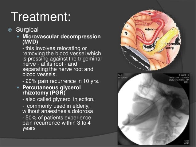 Trigeminal Neuralgia