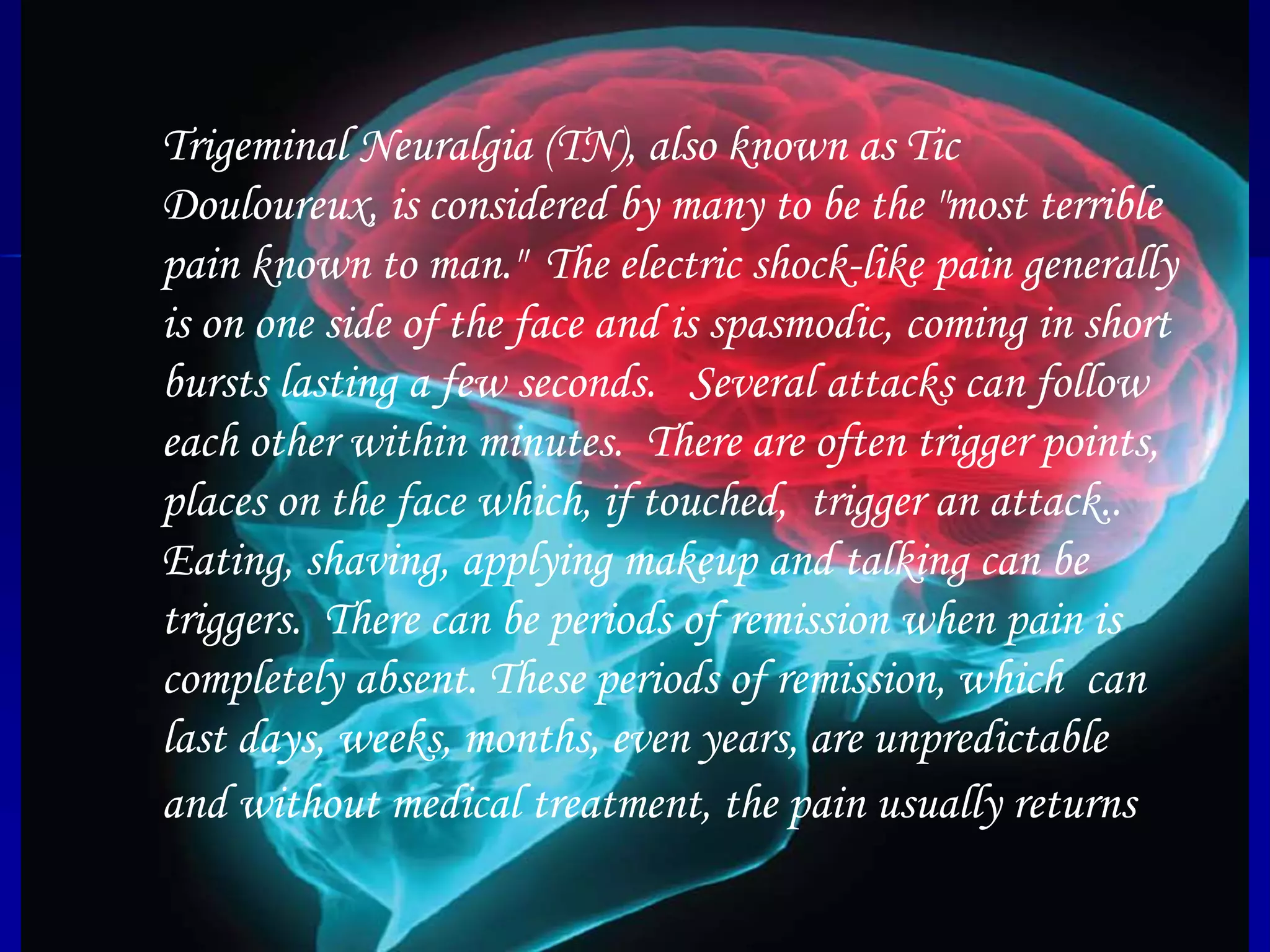 Trigeminal Neuralgia | PPT