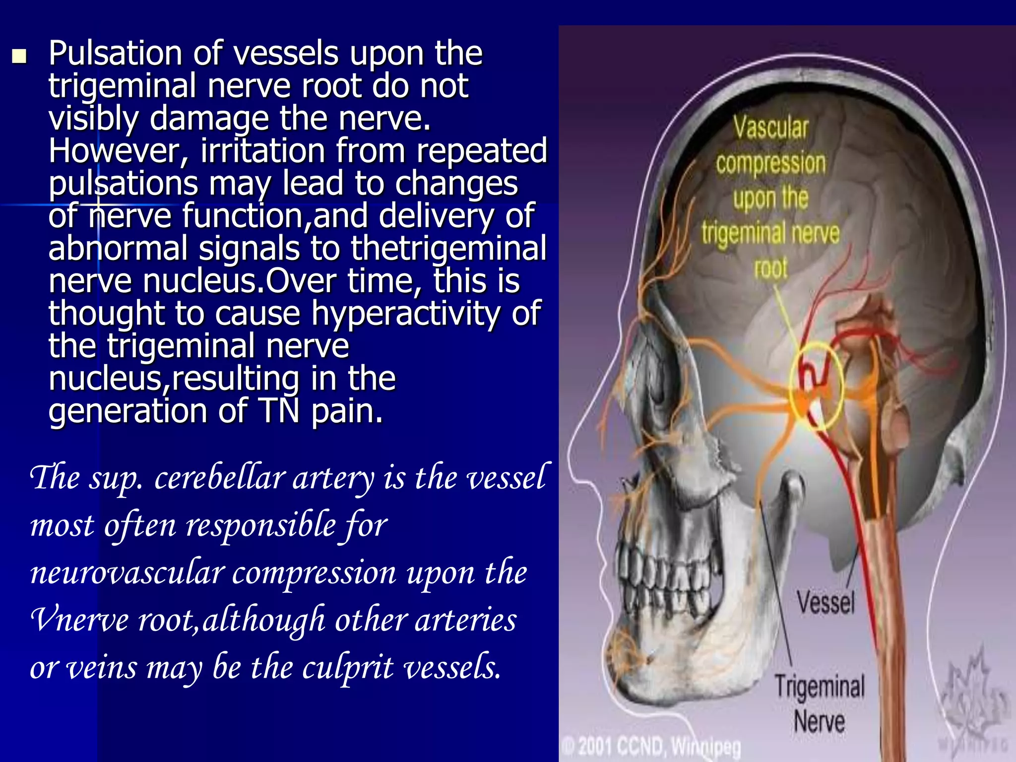 Trigeminal Neuralgia | PPT