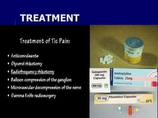 Trigeminal Neuralgia | PPT