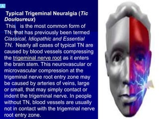 Trigeminal Neuralgia | PPT