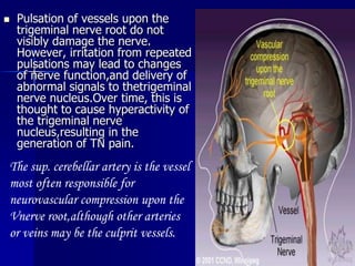 Trigeminal Neuralgia | PPT
