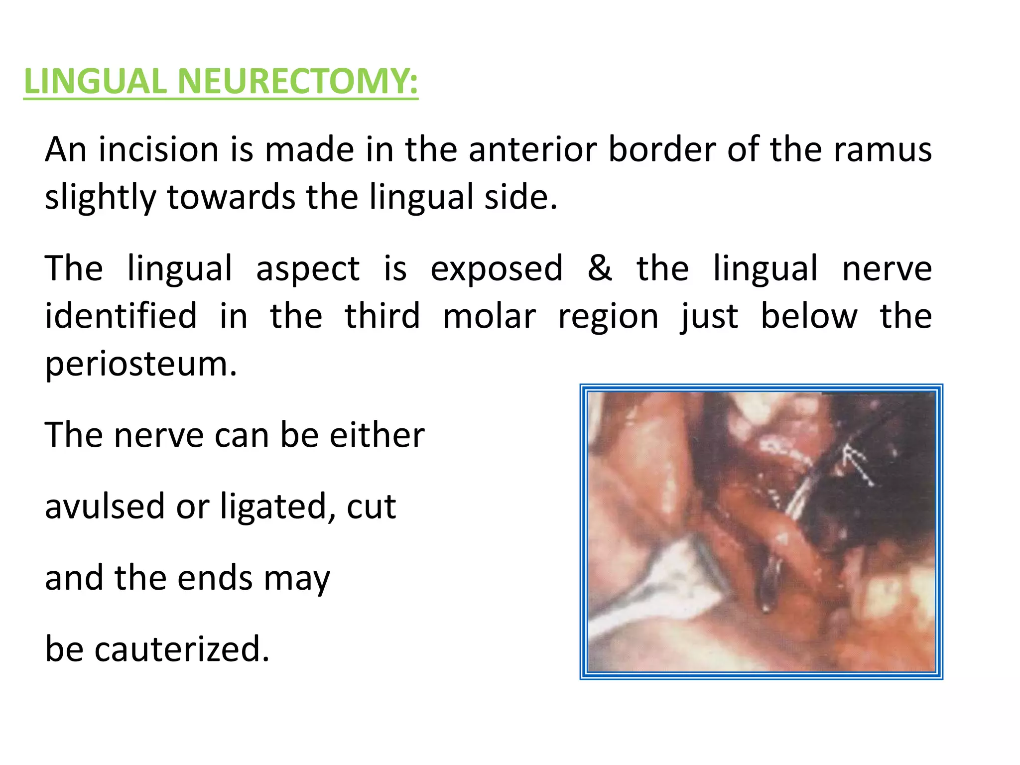 Trigeminal neuralgia in OMFS | PPT