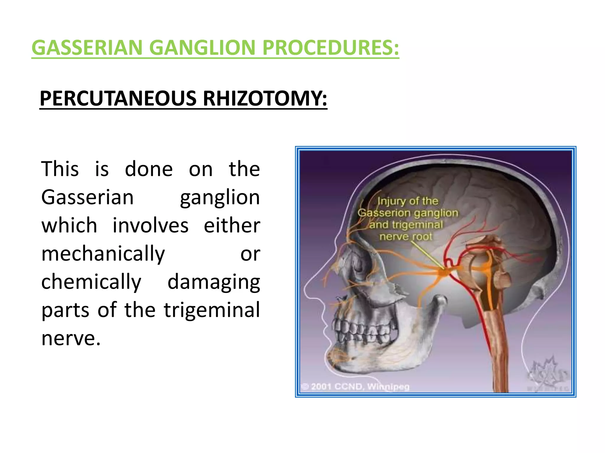 Trigeminal neuralgia in OMFS | PPT