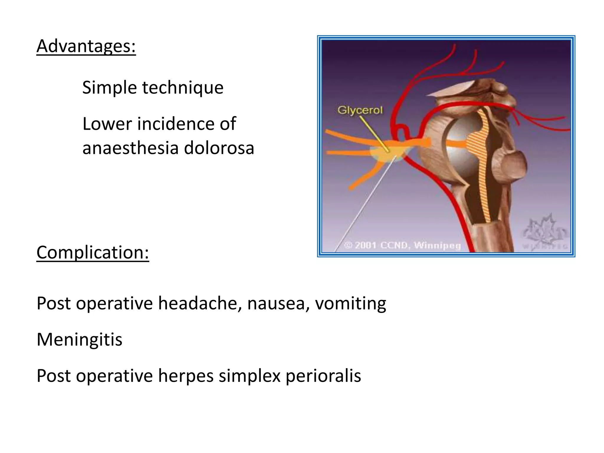 Trigeminal neuralgia in OMFS | PPT