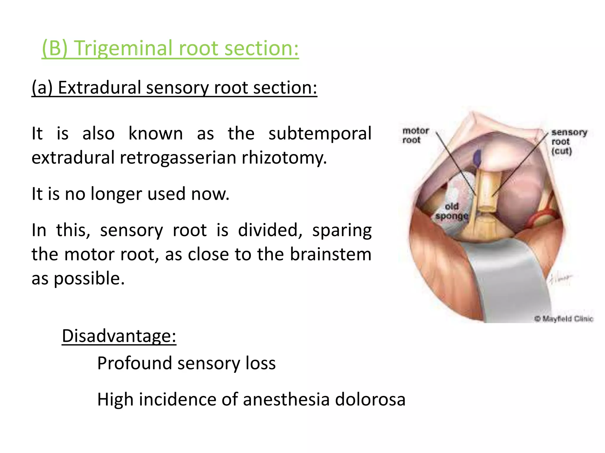 Trigeminal neuralgia in OMFS | PPT