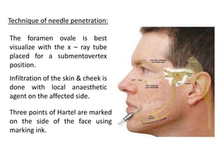 Trigeminal neuralgia in OMFS | PPT