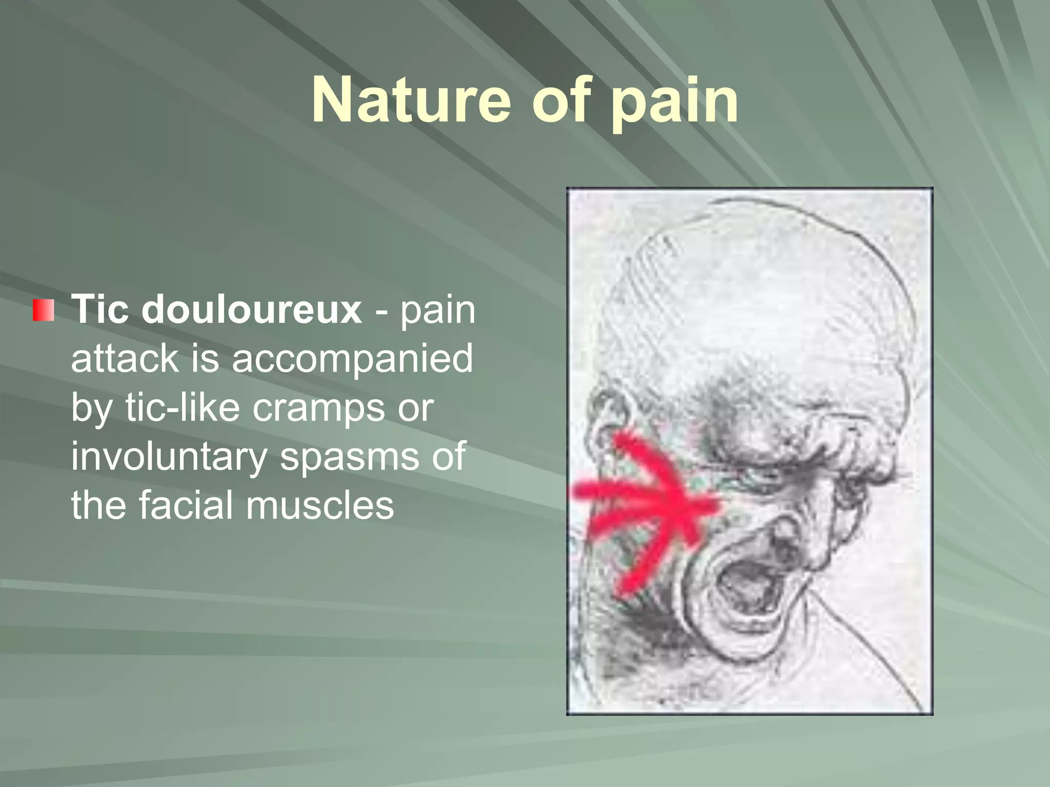 trigeminal neuralgia | PPTX