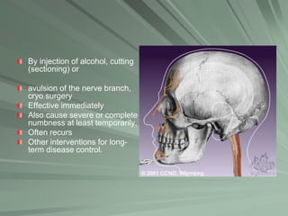 trigeminal neuralgia | PPTX