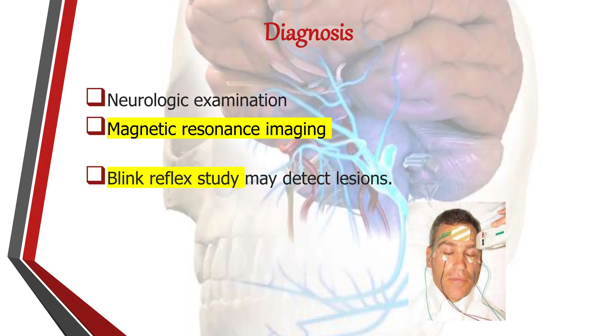 trigeminal neuralgia.pptx