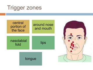 Trigeminal neuralgia new classification and diagnostic grading for | PPT