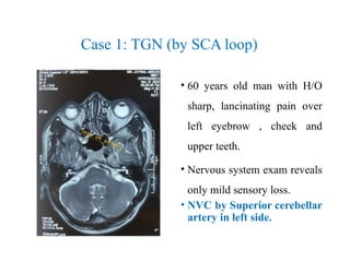 Trigeminal Neuralgia & Microvascular Decompression(MVD).pptx