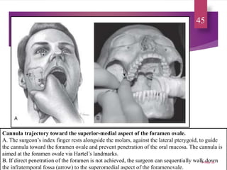 Trigeminal neuralgia praveen | PPTX
