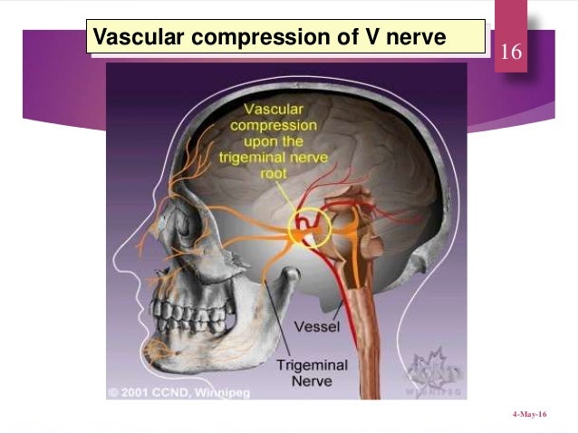 Trigeminal neuralgia praveen