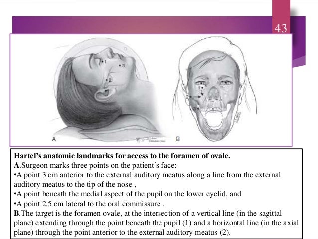 Trigeminal neuralgia praveen