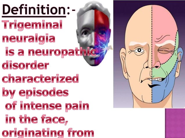 Trigeminal neuralgia presentation Trigeminal neuralgia presentation