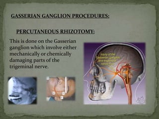 Trigeminal nuralgia | PPTX