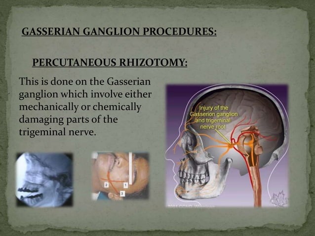 Trigeminal nuralgia | PPT