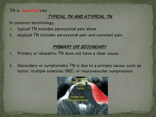 Trigeminal nuralgia | PPTX