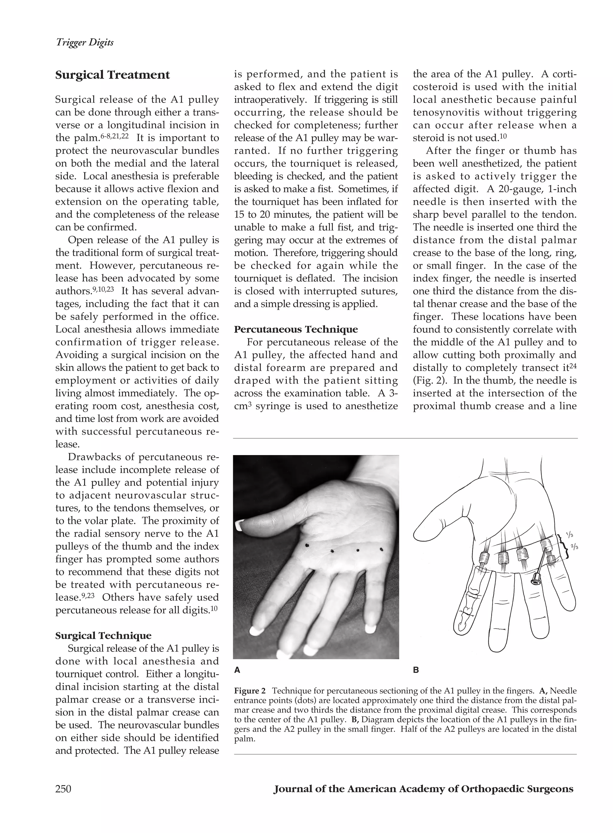 Trigger Finger | PDF