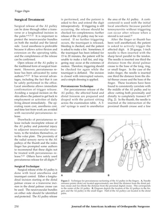 Trigger Finger | PDF