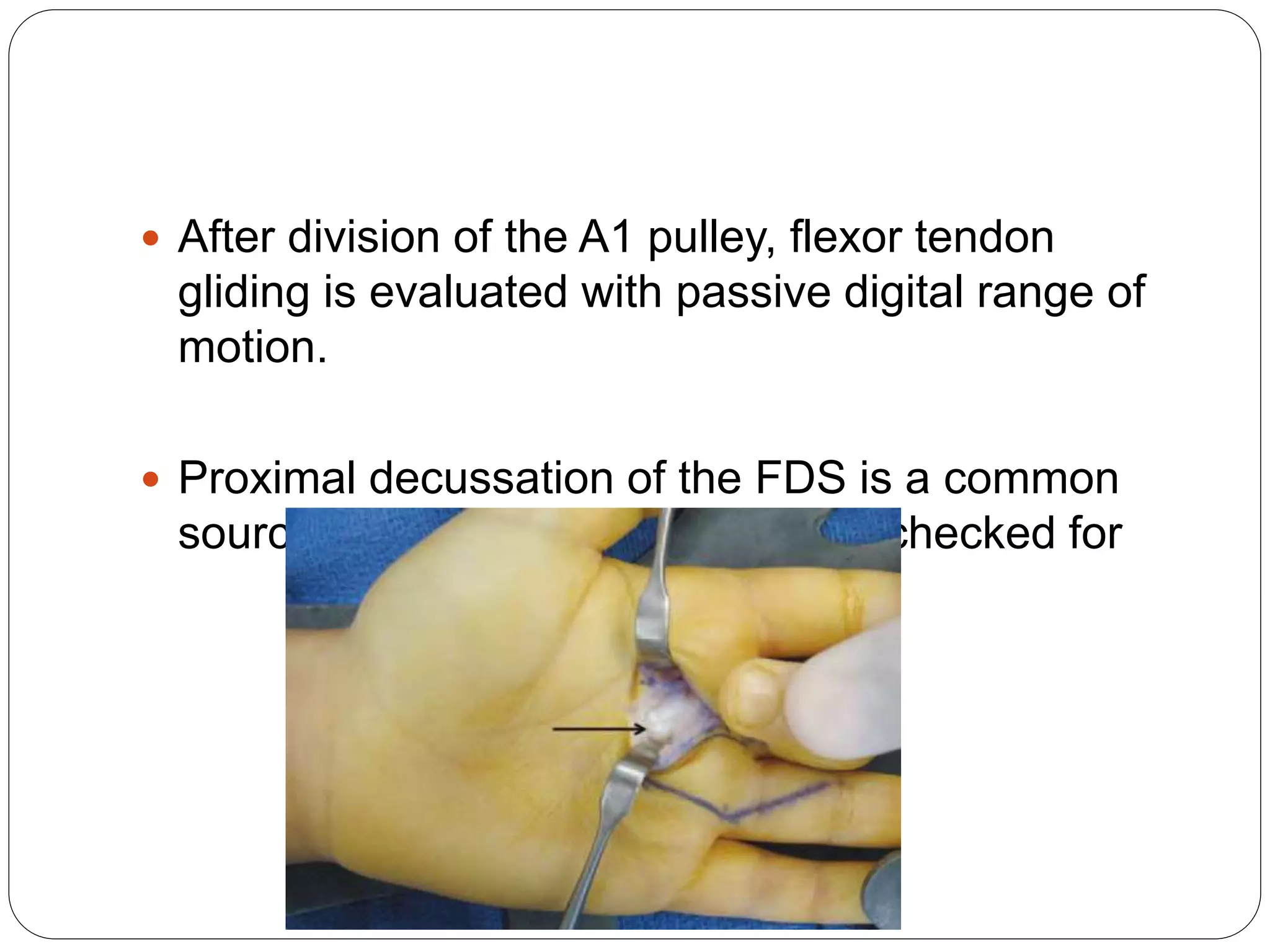 Trigger finger - adult and congenital | PPTX