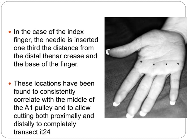 Trigger finger - adult and congenital | PPTX