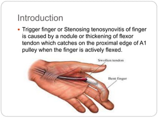 Trigger finger - adult and congenital | PPT