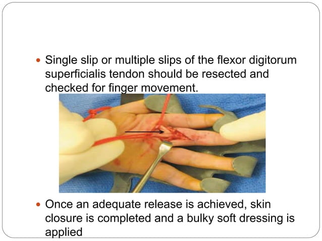 Trigger finger - adult and congenital