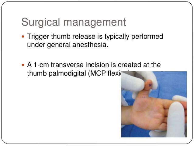 Trigger finger - adult and congenital