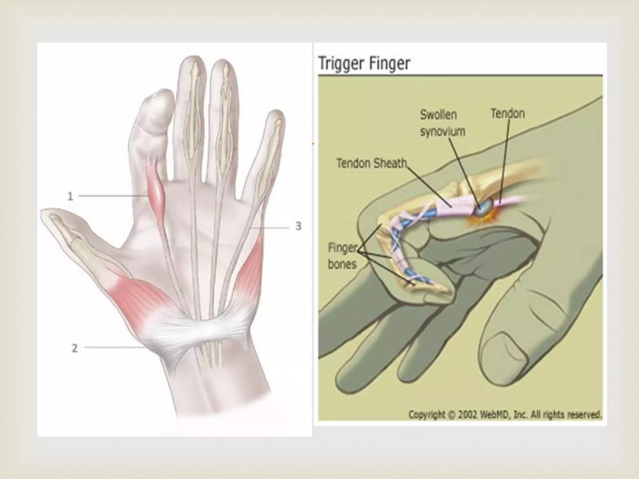 Trigger finger,causes,symptom,management | PPTX