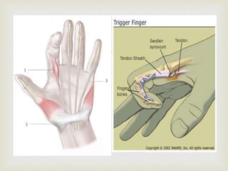 Trigger finger,causes,symptom,management | PPTX