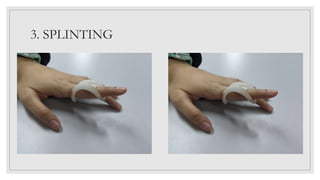 PENGURUSAN TRIGGER FINGER DALAM PEMULIHAN CARAKERJA | PPT