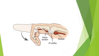 Trigger Finger.pptx | Physical Therapy | Wellness