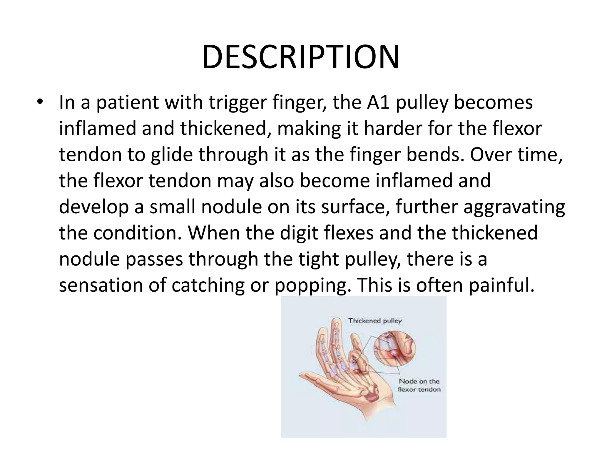 TRIGGER FINGER.pptx