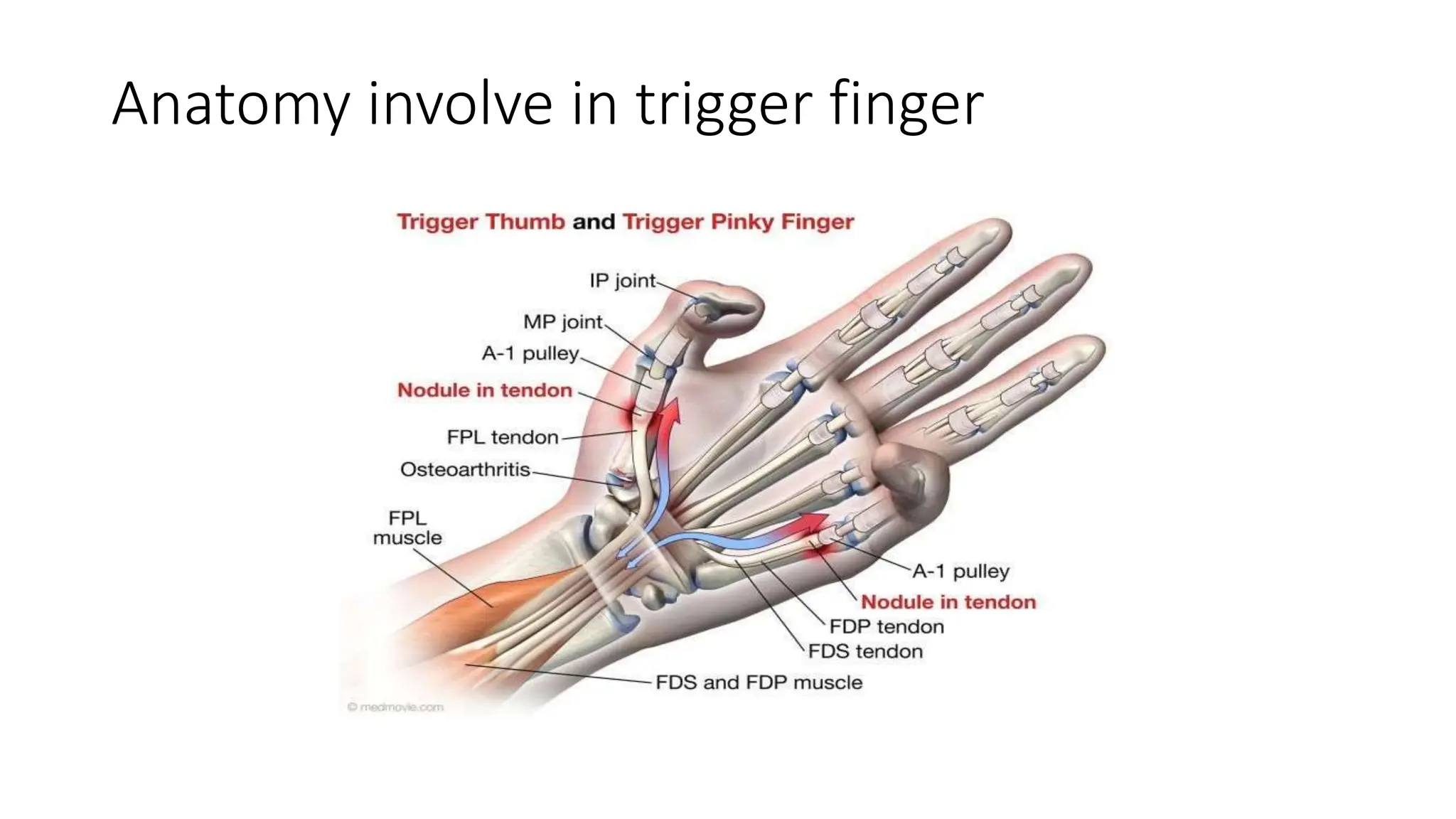 Trigger Finger With Glucocorticoid Injection Ppt