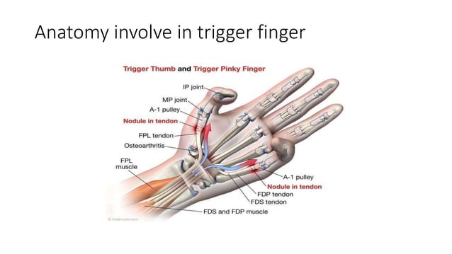 Trigger Finger - with glucocorticoid injection | PPT