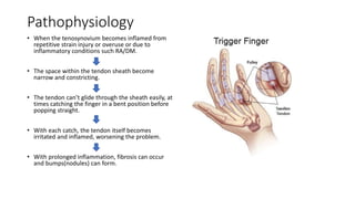 Trigger Finger - with glucocorticoid injection | PPTX