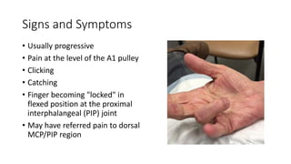 Trigger Finger - with glucocorticoid injection | PPT