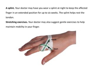 Trigger finger by Kids Orthopedic | PDF