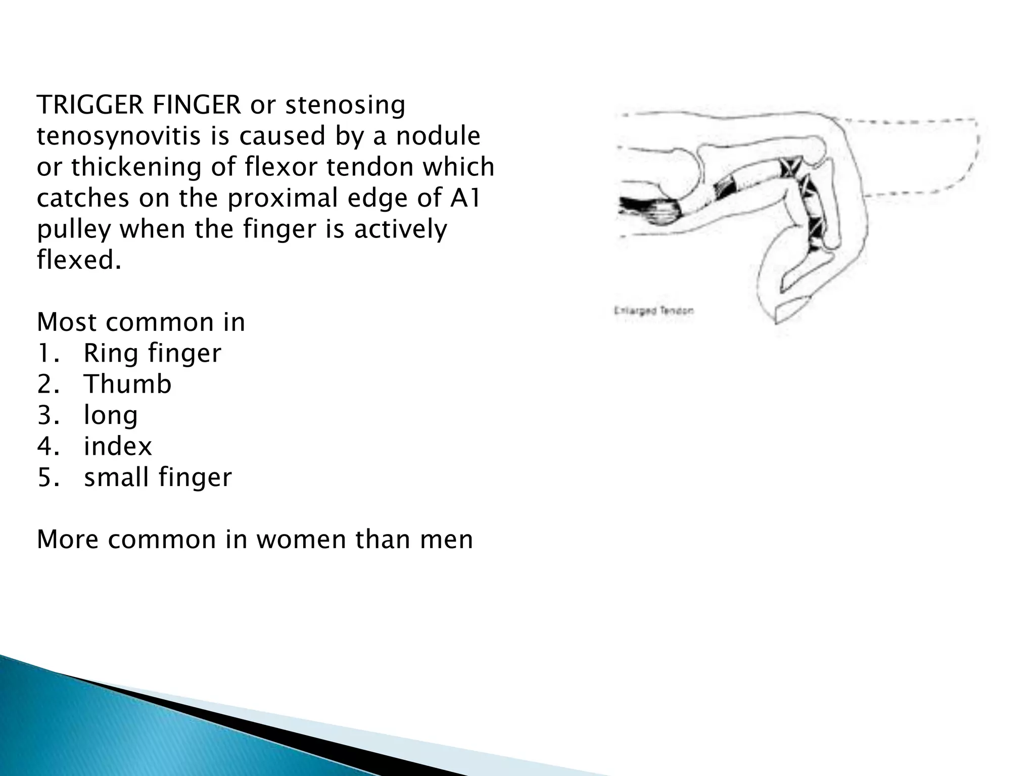 Trigger finger final | PPTX