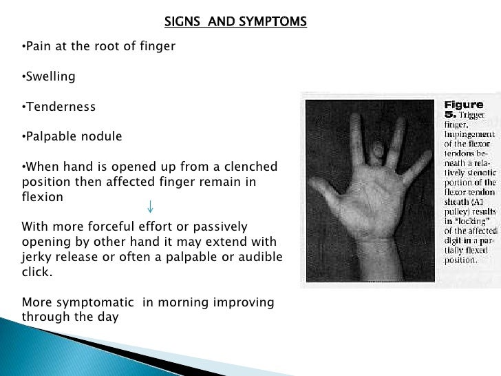 Trigger Finger Definition Etiology Symptoms Diagnosis