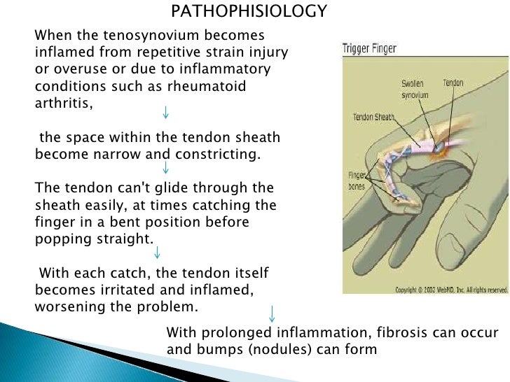 Trigger Finger Definition Etiology Symptoms Diagnosis