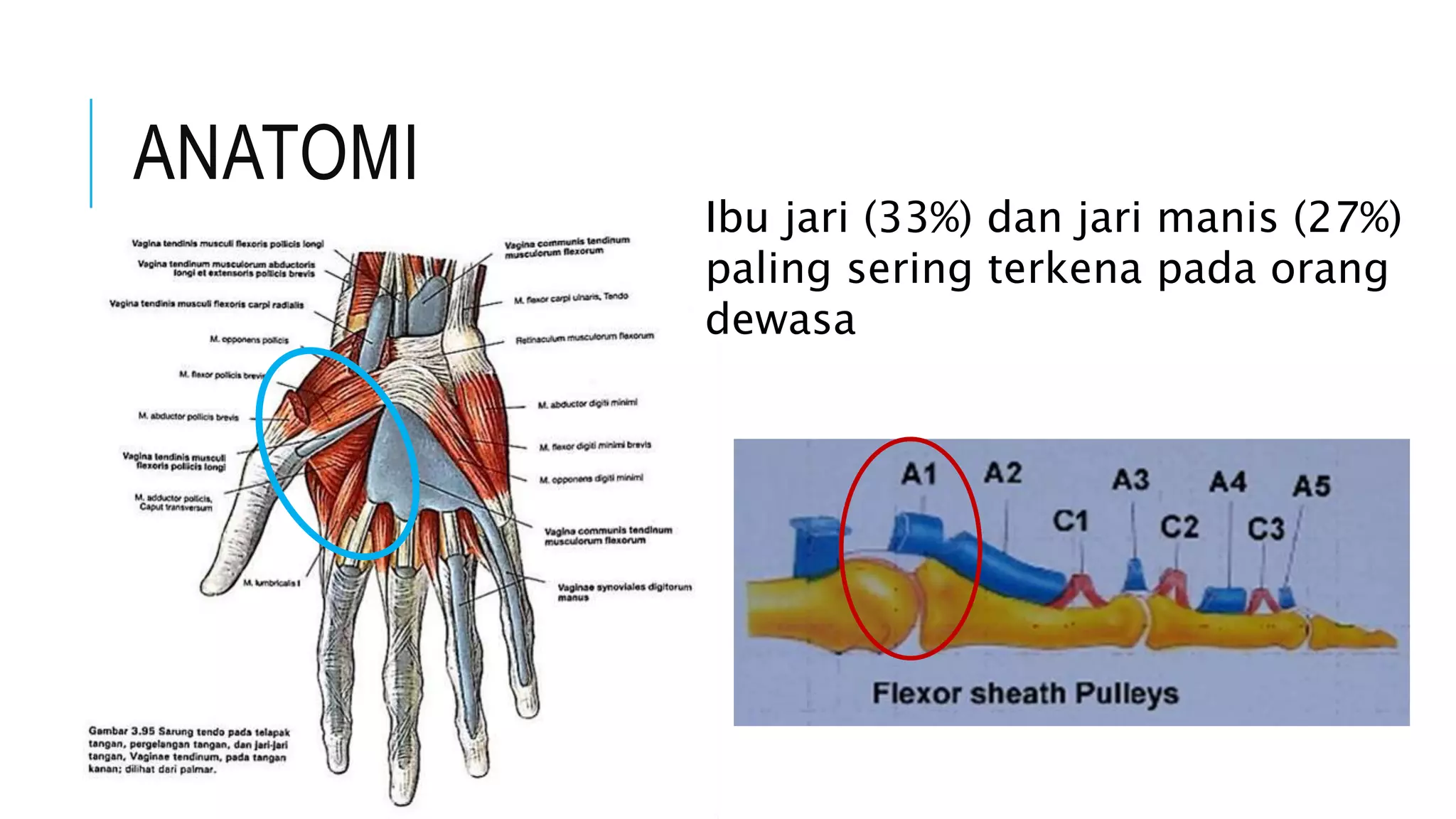 TRIGGER FINGER MHD.pptx