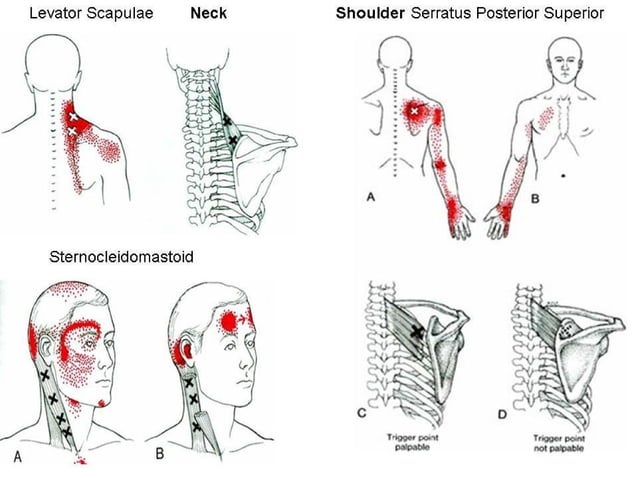Trigger point 3a | PPT