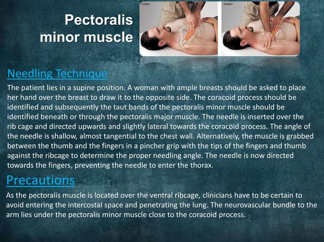 Trigger Point Dry Needling | PPSX