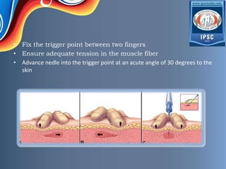 Trigger point injection | PPTX