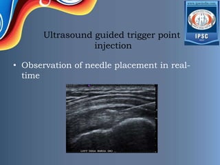 Trigger point injection | PPTX