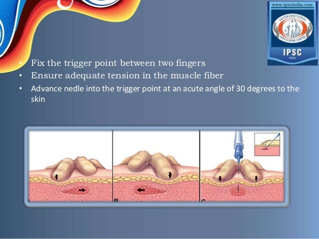 Trigger point injection