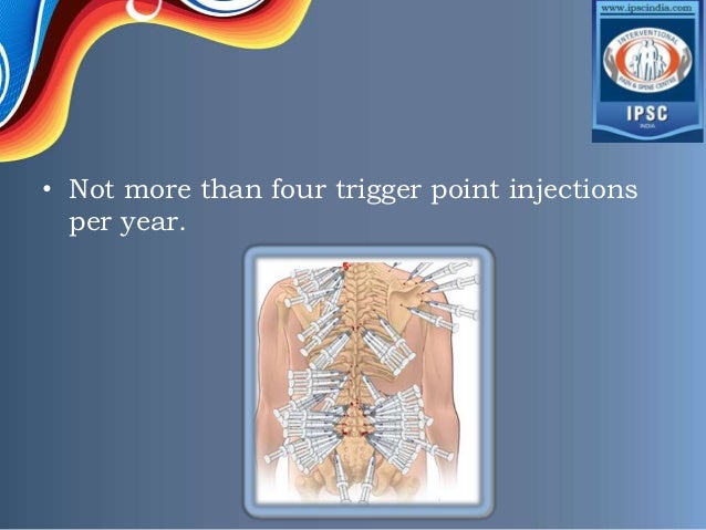 Trigger point injection